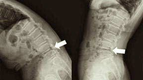 Getting out of neutral: the risks and rewards of lumbar spine flexion ...